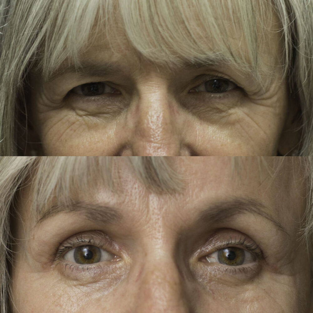 "Brow Forehead | Lift in Utah | Book Eyebrow Lift Surgery"