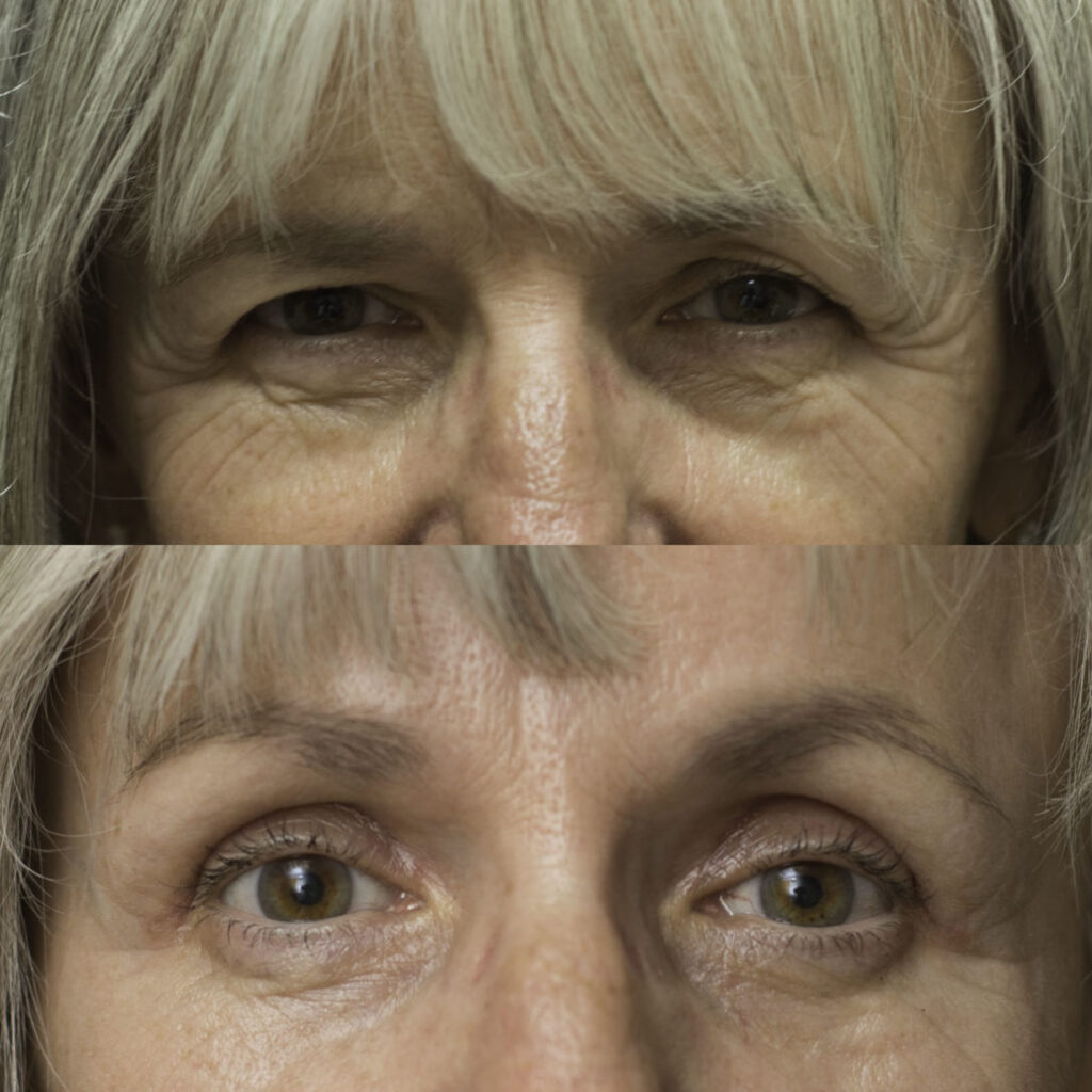 "Brow Forehead | Lift in Utah | Book Eyebrow Lift Surgery"